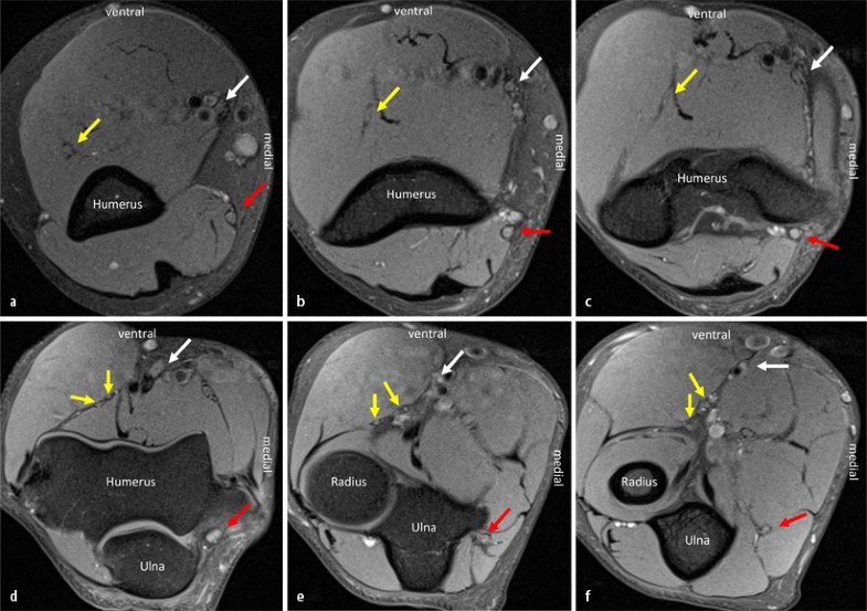 Bildgebung des Ellenbogengelenks mit Fokus MRT | SpringerLink