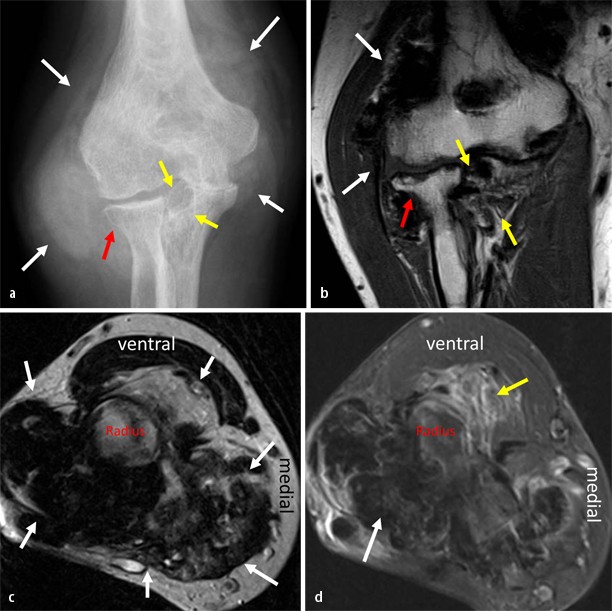 Bildgebung des Ellenbogengelenks mit Fokus MRT | SpringerLink