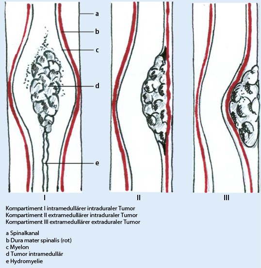 Pädiatrische intraspinale Neoplasien | SpringerLink