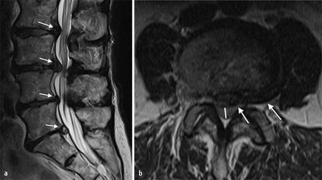 Spinalkanalstenose | SpringerLink