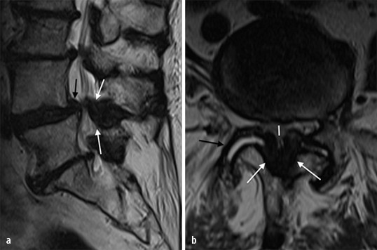 Spinalkanalstenose | SpringerLink