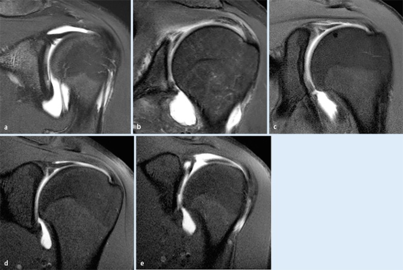 Klassifikation von Normvarianten des Labrums und Labrumverletzungen ...