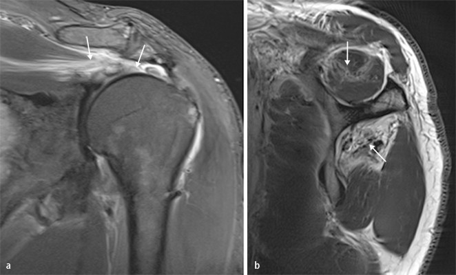 Systematik der Verletzungen von Rotatorenmanschette und Bizepssehne ...