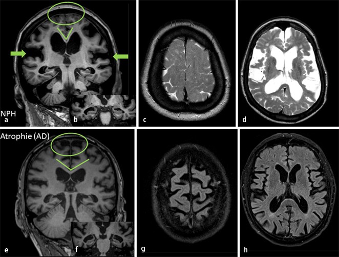 Normaldruckhydrozephalus | SpringerLink