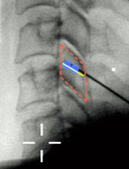 Interventionen an Facettengelenken | SpringerLink