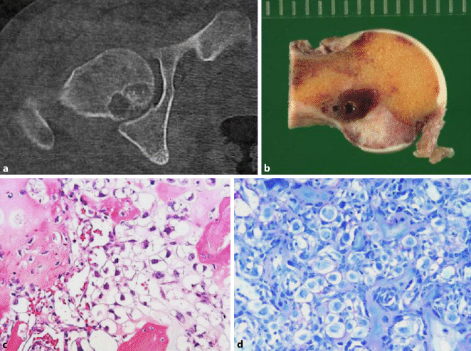 Chondrogene Knochentumoren | SpringerLink