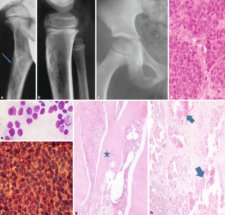 Ewing-Sarkom, fibrogene Tumoren, Riesenzelltumor, Hämangiom des ...