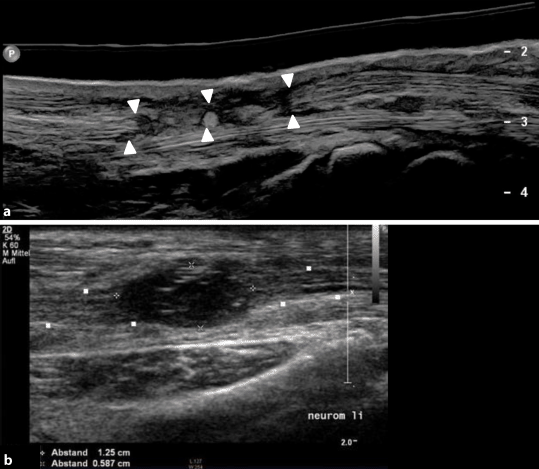 Nervenverletzungen und traumatische Läsionen des Plexus brachialis ...