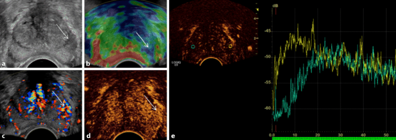 Ultraschall der Prostata | SpringerLink