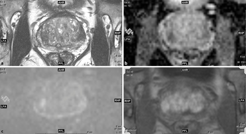 Multiparametrische MRT der Prostata | SpringerLink