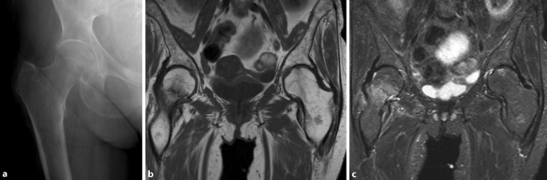 Posttherapeutische Veränderungen am Knochenmark | SpringerLink