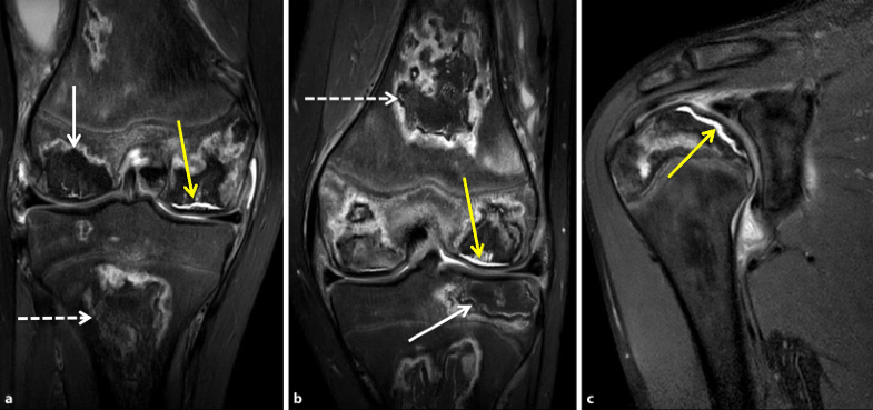 Postoperative und posttherapeutische Veränderungen nach primären ...