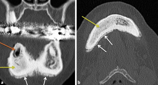 Postoperative und posttherapeutische Veränderungen nach primären ...