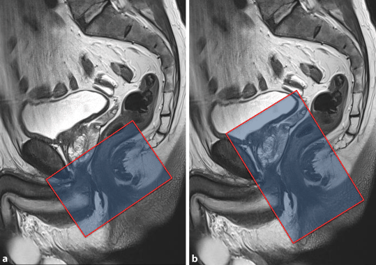 Perianale entzündliche Erkrankungen | SpringerLink