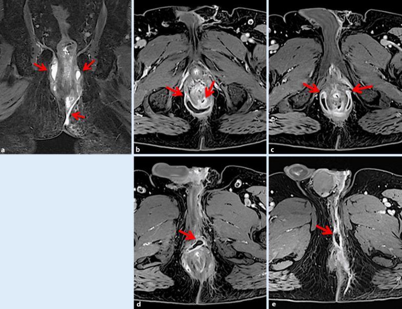 Perianale entzündliche Erkrankungen | SpringerLink