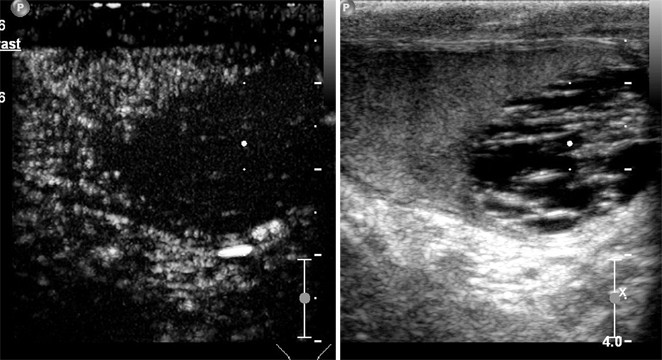 Tubuläre Ektasie des Rete testis | SpringerLink