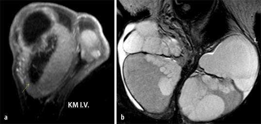 Tubuläre Ektasie des Rete testis | SpringerLink