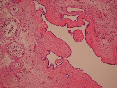 Tubuläre Ektasie des Rete testis | SpringerLink