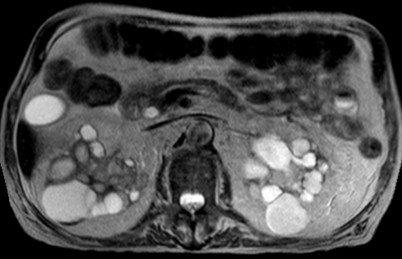 Einlage einer perkutanen Nephrostomie im offenen ...