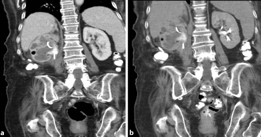 Diagnostik und Therapie retroperitonealer Abszesse | SpringerLink