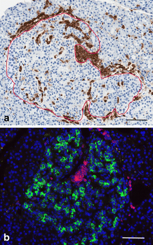 The diagnosis of insulitis in human type 1 diabetes | SpringerLink