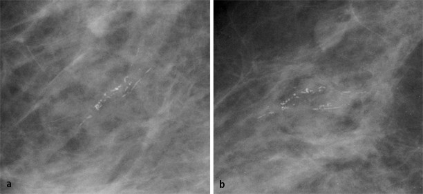 Vorstufen des Mammakarzinoms | SpringerLink