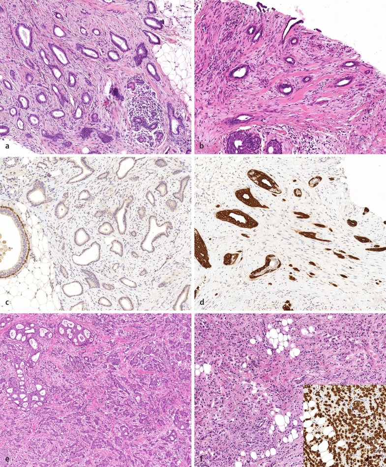Klinische und morphologische Parameter beim Mammakarzinom | SpringerLink