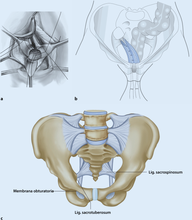 Therapie des Descensus genitalis | SpringerLink