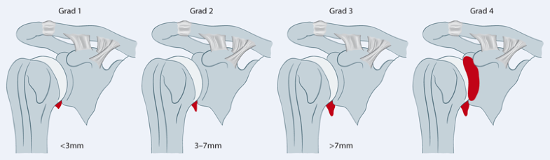 Instabilitätsarthropathie | SpringerLink