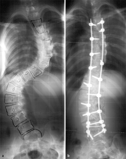 Selektive Fusionsmöglichkeiten der idiopathischen Skoliose unter ...