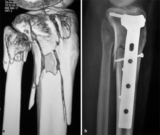 Konventionelle Plattenosteosynthese | SpringerLink