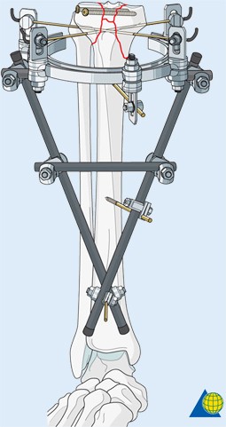 Fixateur-externe-Osteosynthese | SpringerLink