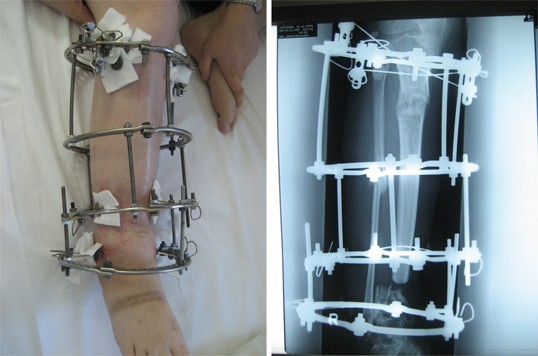 Fixateur-externe-Osteosynthese | SpringerLink