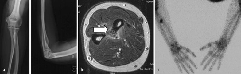 Gutartige Knochentumoren | SpringerLink