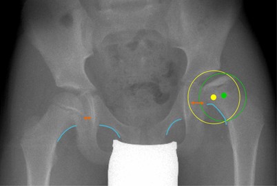 Aktuelle Behandlungsstrategie des Morbus Perthes | SpringerLink