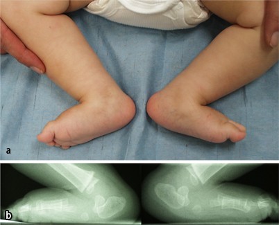 Talus verticalis | SpringerLink