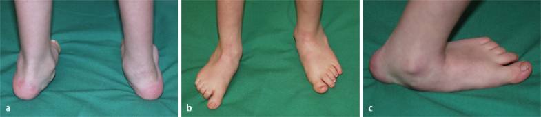 Talus verticalis | SpringerLink