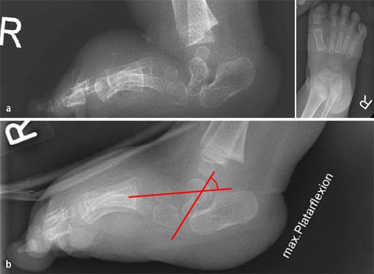 Talus verticalis | SpringerLink