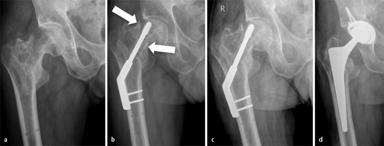 Komplikationen nach Osteosynthese des proximalen Femurs | SpringerLink