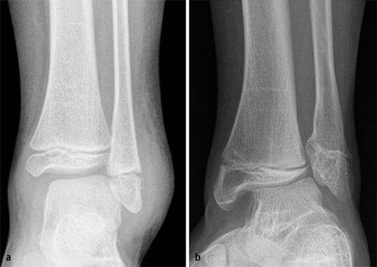 Posttraumatische Komplikationen am kindlichen Sprunggelenk | SpringerLink