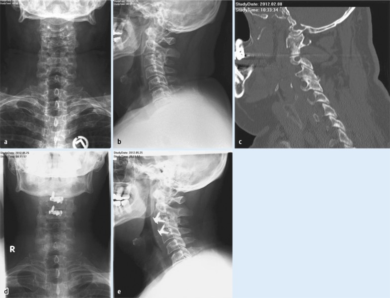 Spondylarthrose an der Halswirbelsäule | SpringerLink