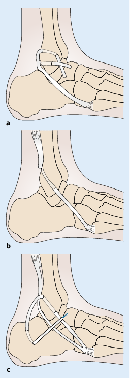 Laterale Instabilität des oberen Sprunggelenks | SpringerLink