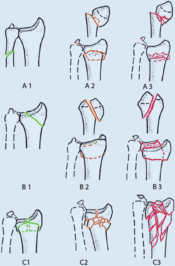 Distale Radiusfraktur | SpringerLink
