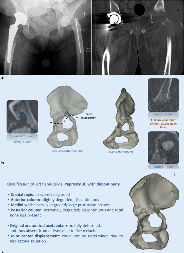 Acetabular defect classification in times of 3D imaging and patient ...