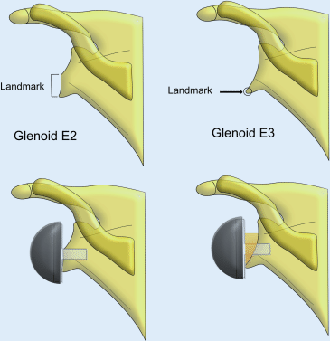 Superior glenoid inclination and glenoid bone loss | SpringerLink