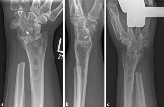 Endoprothetik am distalen Radioulnargelenk | SpringerLink