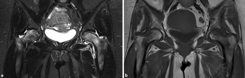Das Knochenmarködem – Differenzialdiagnose zur aseptischen ...
