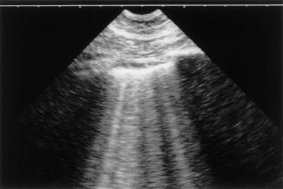 The “lung pulse”: an early ultrasound sign of complete atelectasis ...