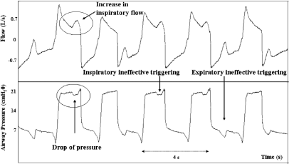 Patient-ventilator asynchrony during assisted mechanical ventilation ...