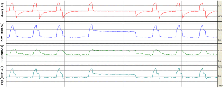 Understanding the setting of PEEP from esophageal pressure in patients ...